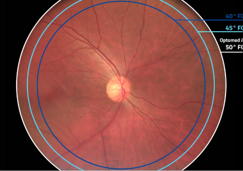 Optomed Aurora – Malaysia Ophthalmic Innovator